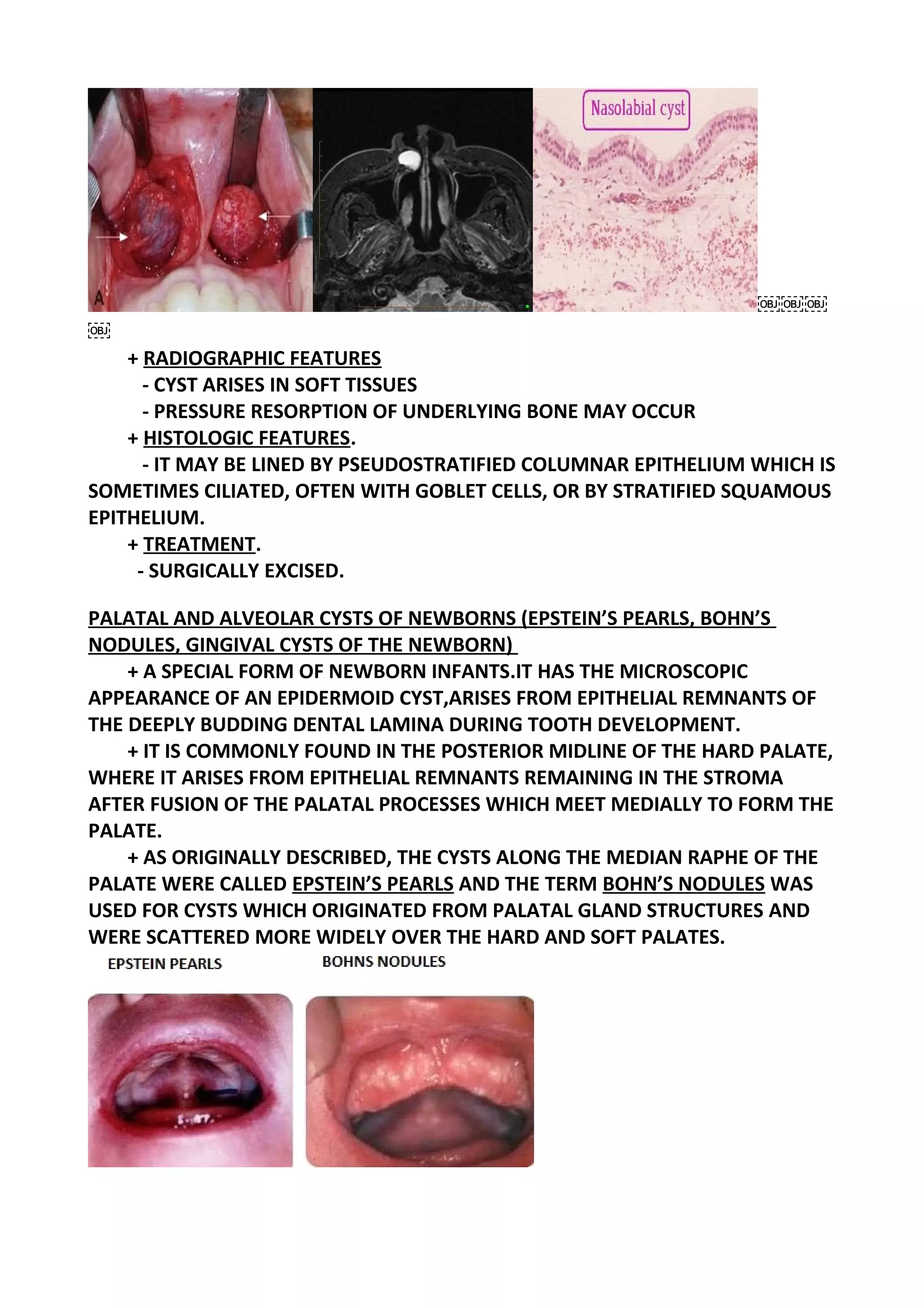 fissural cyst or developmental cyst | ODT
