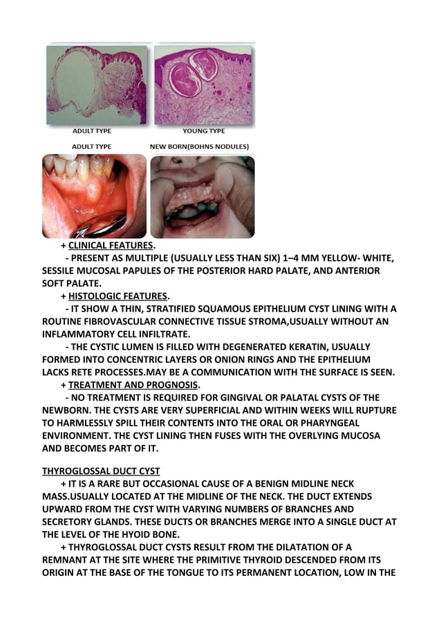 fissural cyst or developmental cyst | ODT