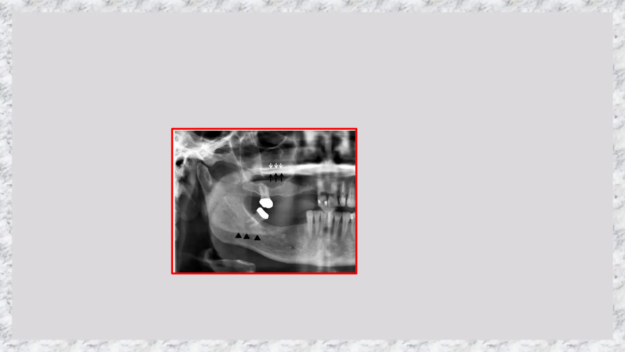 OPG (ORTHOPANTOMOGRAPHY) - PANORAMIC RADIOGRAPHY- DR PRIYANKA | PPTX