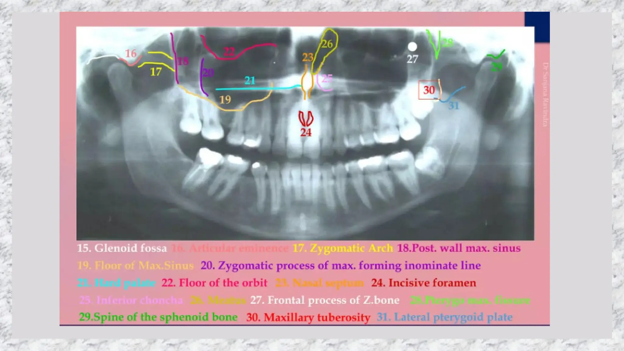 OPG (ORTHOPANTOMOGRAPHY) - PANORAMIC RADIOGRAPHY- DR PRIYANKA | PPTX