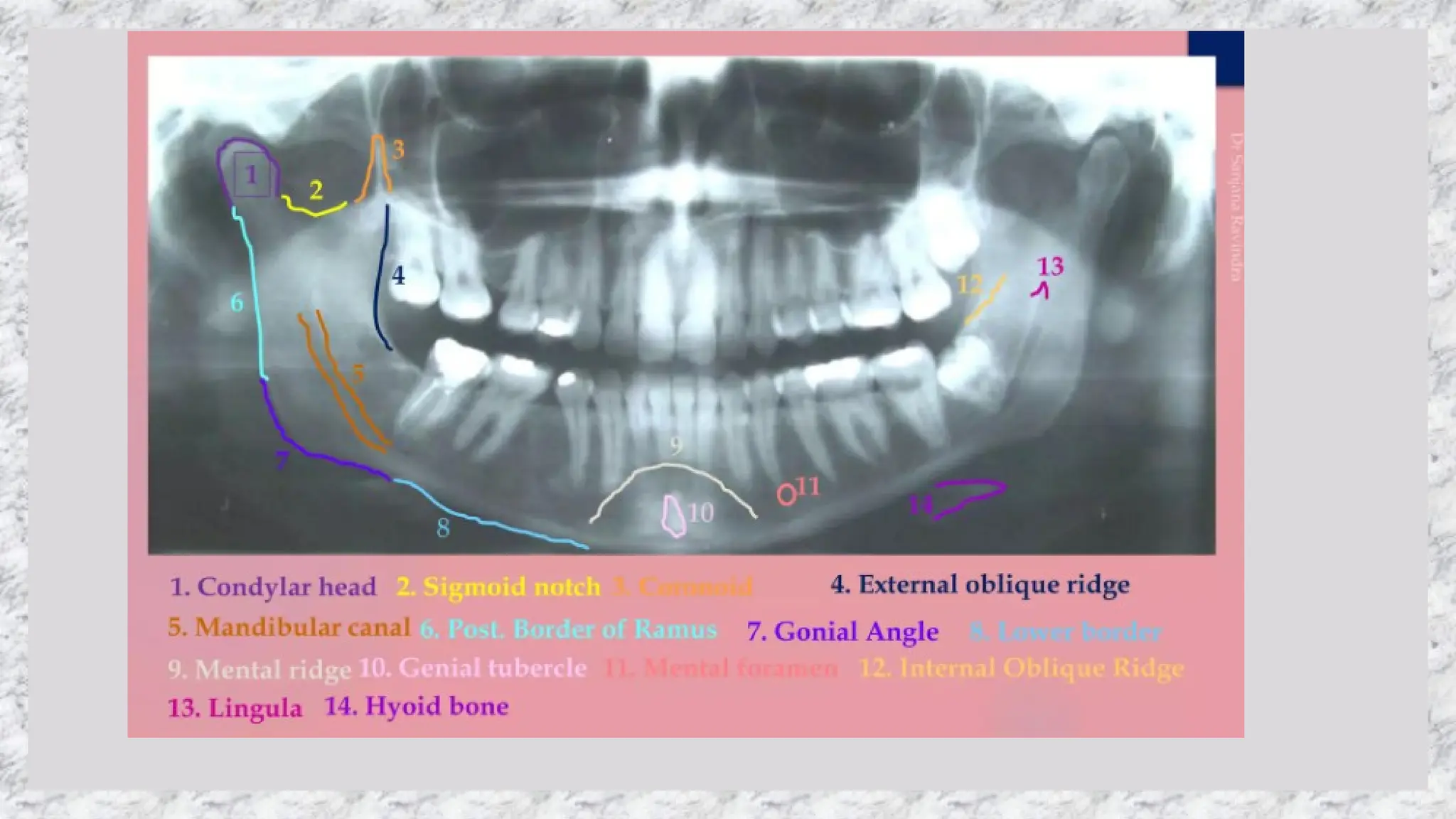 OPG (ORTHOPANTOMOGRAPHY) - PANORAMIC RADIOGRAPHY- DR PRIYANKA | PPTX