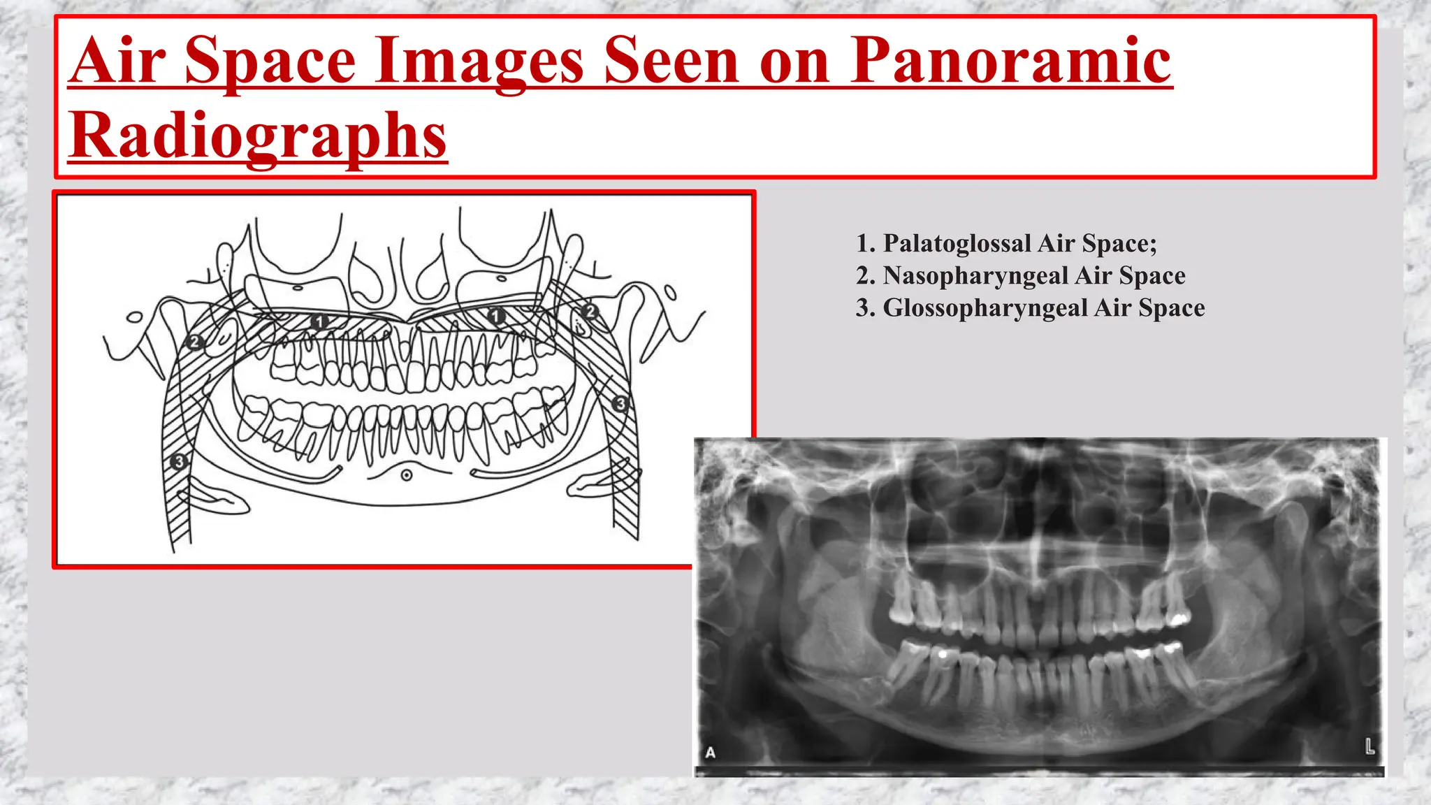 OPG (ORTHOPANTOMOGRAPHY) - PANORAMIC RADIOGRAPHY- DR PRIYANKA | PPTX