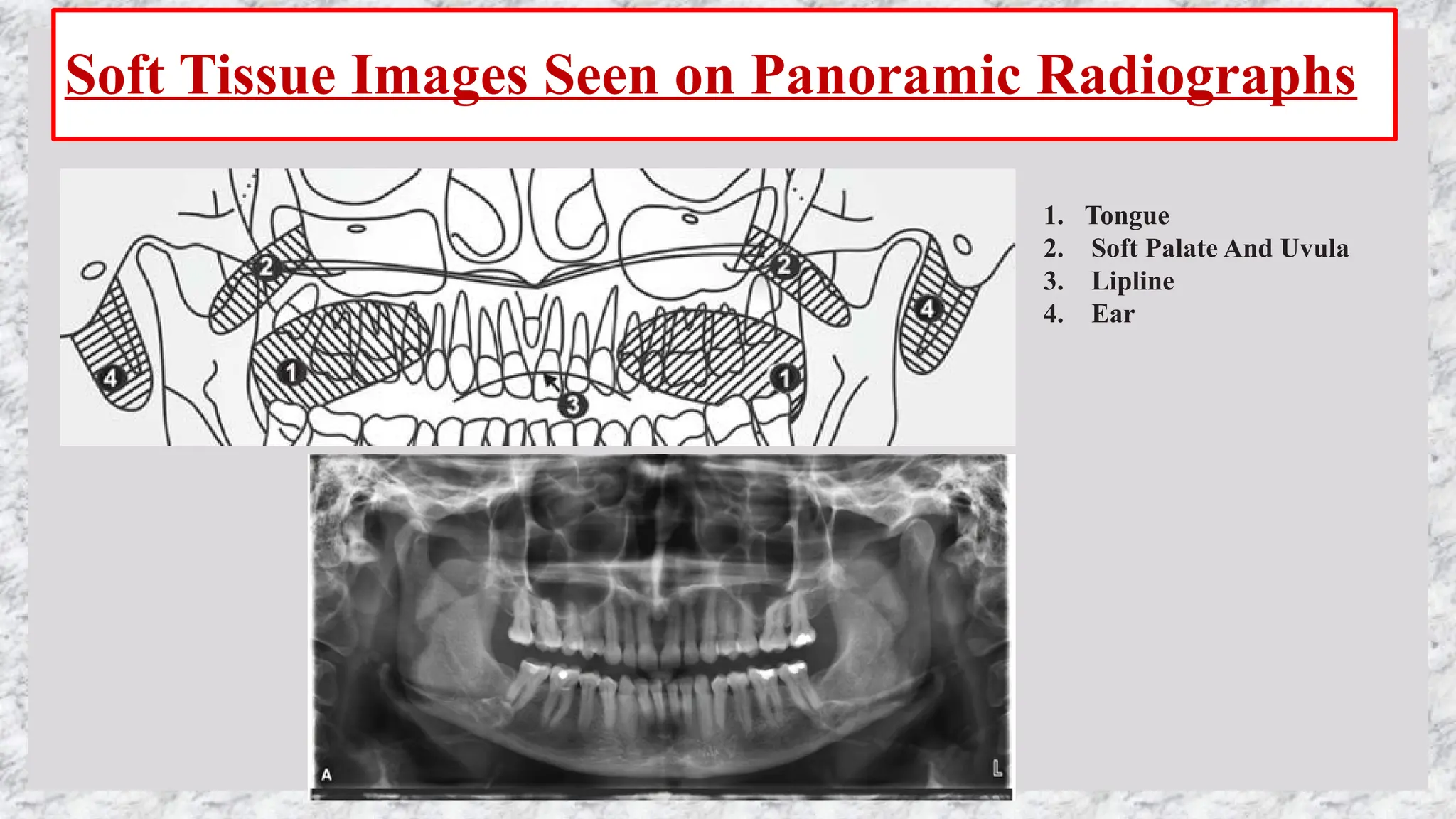 OPG (ORTHOPANTOMOGRAPHY) - PANORAMIC RADIOGRAPHY- DR PRIYANKA | PPTX