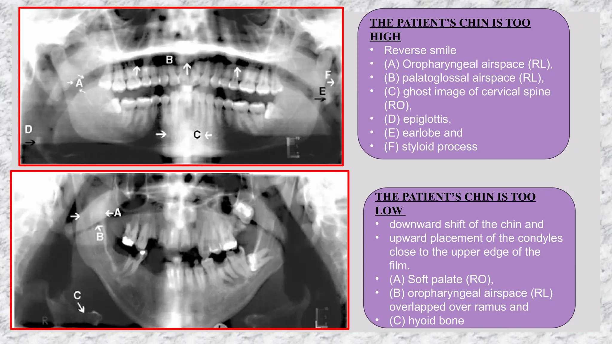 OPG (ORTHOPANTOMOGRAPHY) - PANORAMIC RADIOGRAPHY- DR PRIYANKA | PPTX
