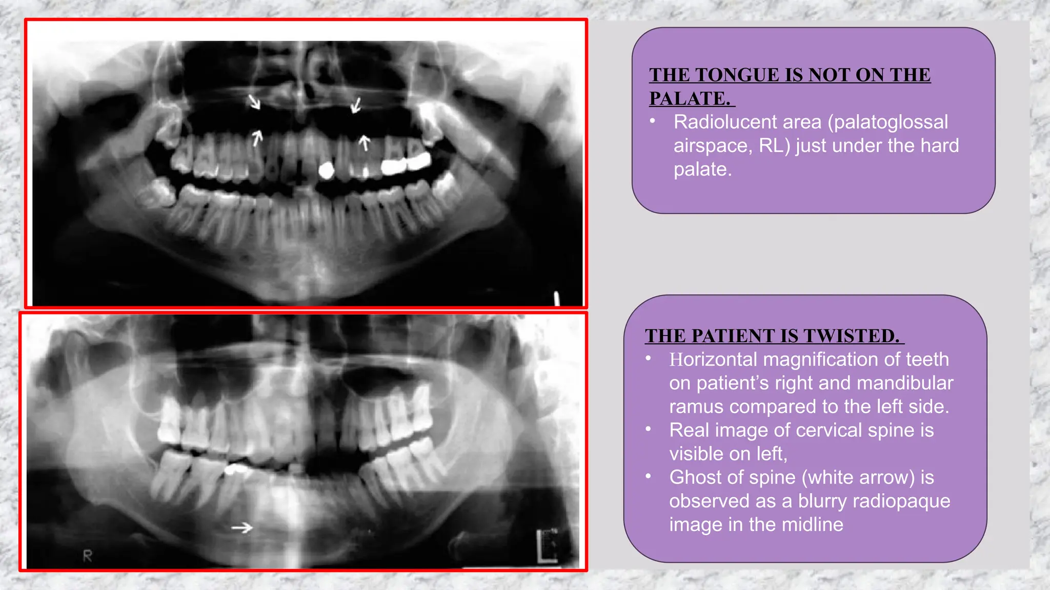 OPG (ORTHOPANTOMOGRAPHY) - PANORAMIC RADIOGRAPHY- DR PRIYANKA | PPTX