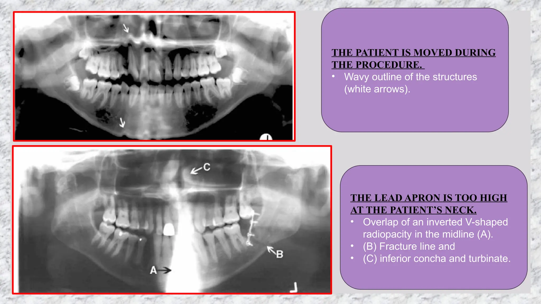 OPG (ORTHOPANTOMOGRAPHY) - PANORAMIC RADIOGRAPHY- DR PRIYANKA | PPTX