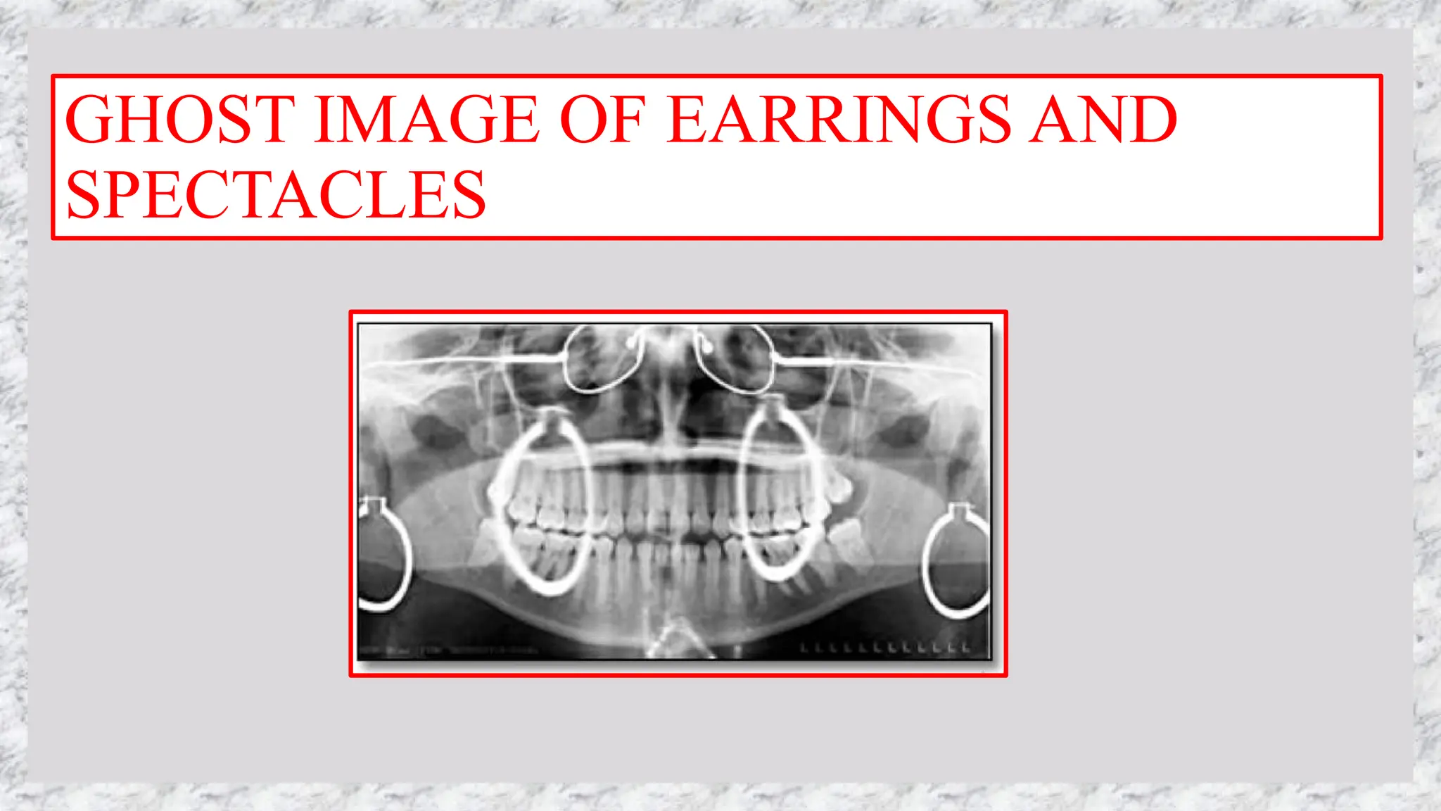 OPG (ORTHOPANTOMOGRAPHY) - PANORAMIC RADIOGRAPHY- DR PRIYANKA | PPTX