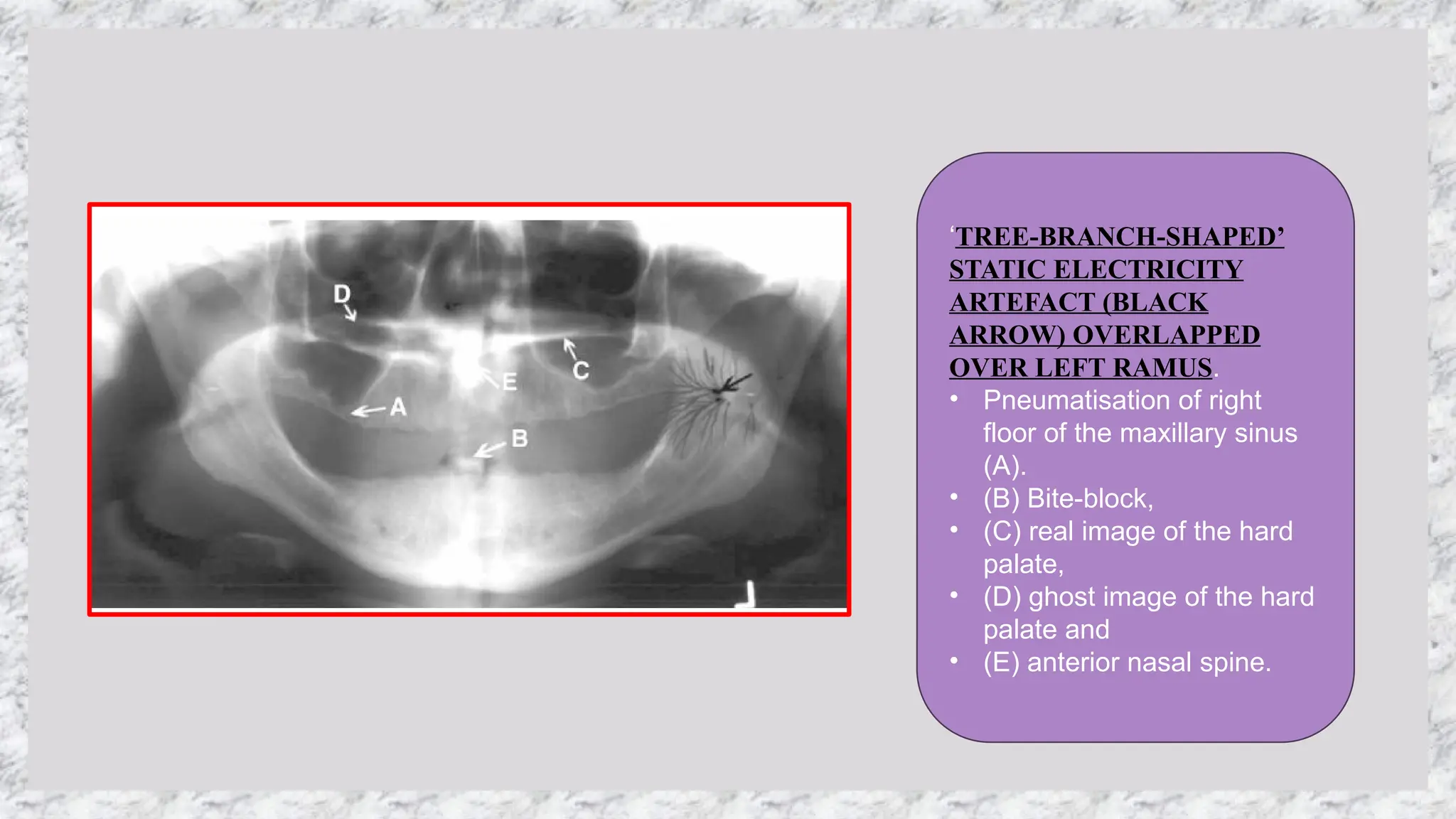 OPG (ORTHOPANTOMOGRAPHY) - PANORAMIC RADIOGRAPHY- DR PRIYANKA | PPTX