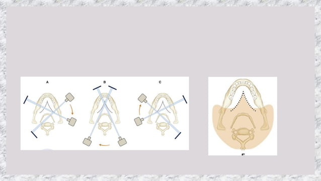 OPG (ORTHOPANTOMOGRAPHY) - PANORAMIC RADIOGRAPHY- DR PRIYANKA | PPTX