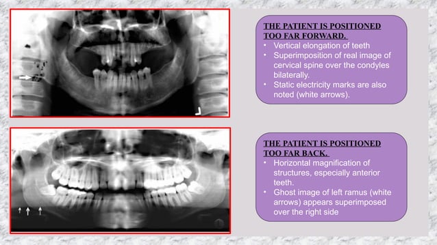 OPG (ORTHOPANTOMOGRAPHY) - PANORAMIC RADIOGRAPHY- DR PRIYANKA | PPTX
