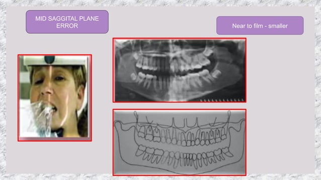 OPG (ORTHOPANTOMOGRAPHY) - PANORAMIC RADIOGRAPHY- DR PRIYANKA | PPTX