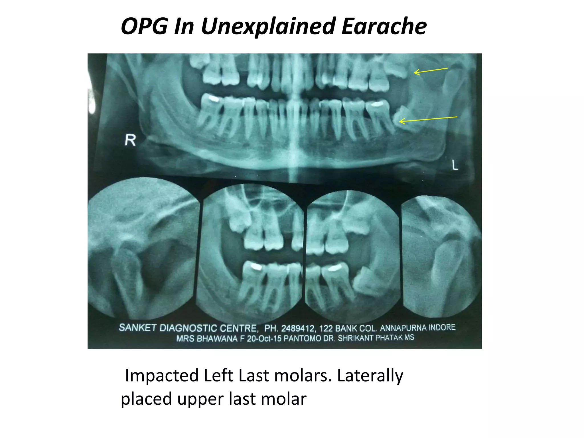 Opg in unexplained earache | PPTX