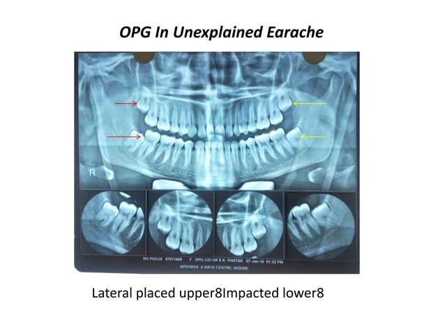 Opg in unexplained earache | PPT