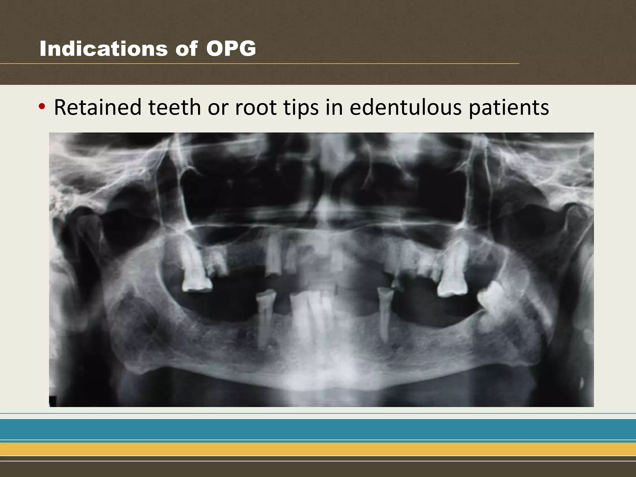 Opg and lateral cephalometric | PPT