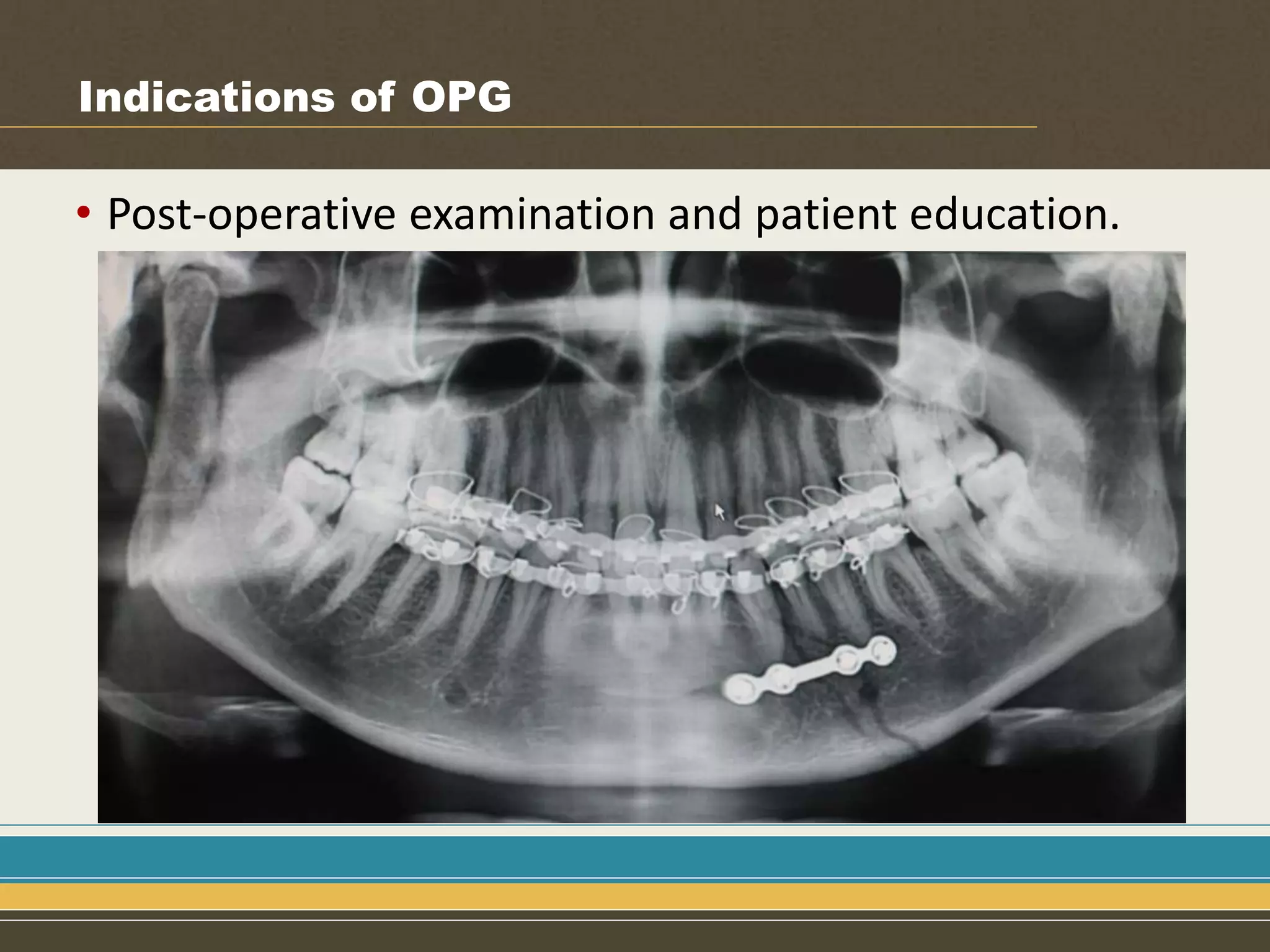 Opg and lateral cephalometric | PPT