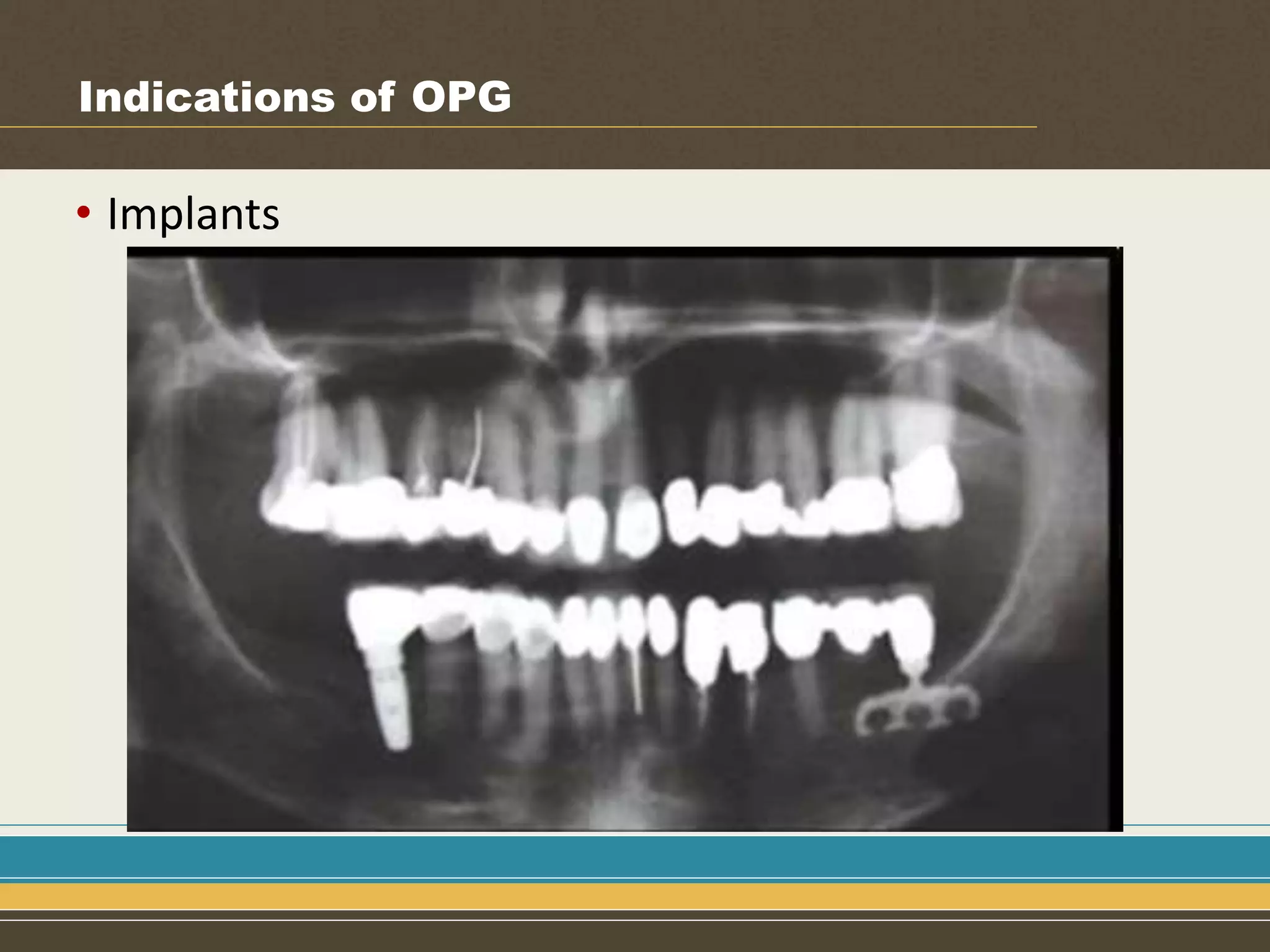 Opg and lateral cephalometric | PPT