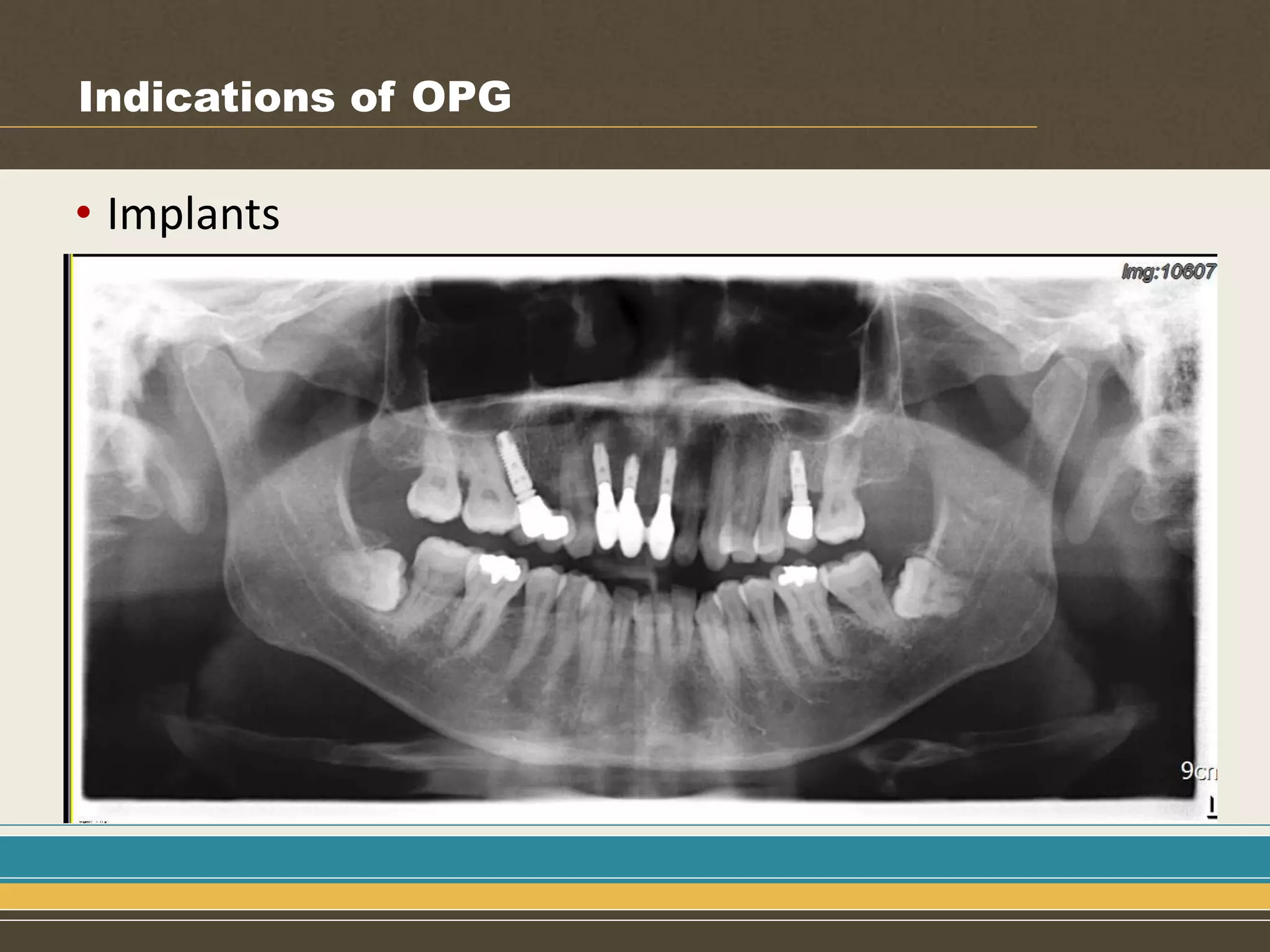 Opg and lateral cephalometric | PPT