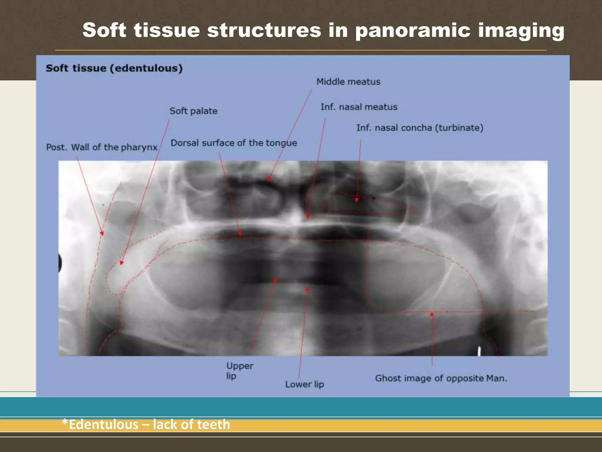 Opg and lateral cephalometric | PPT