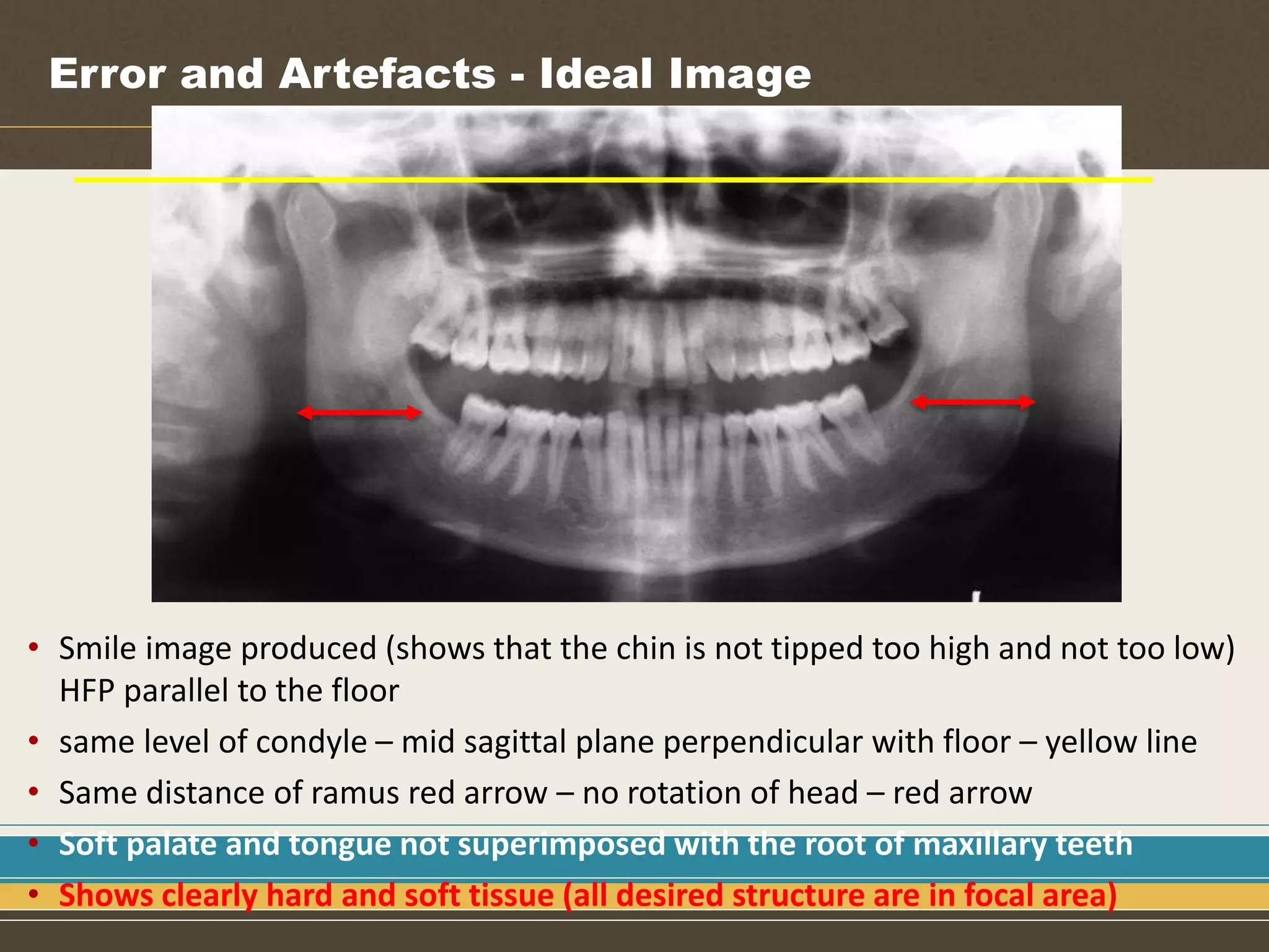 Opg and lateral cephalometric | PPT