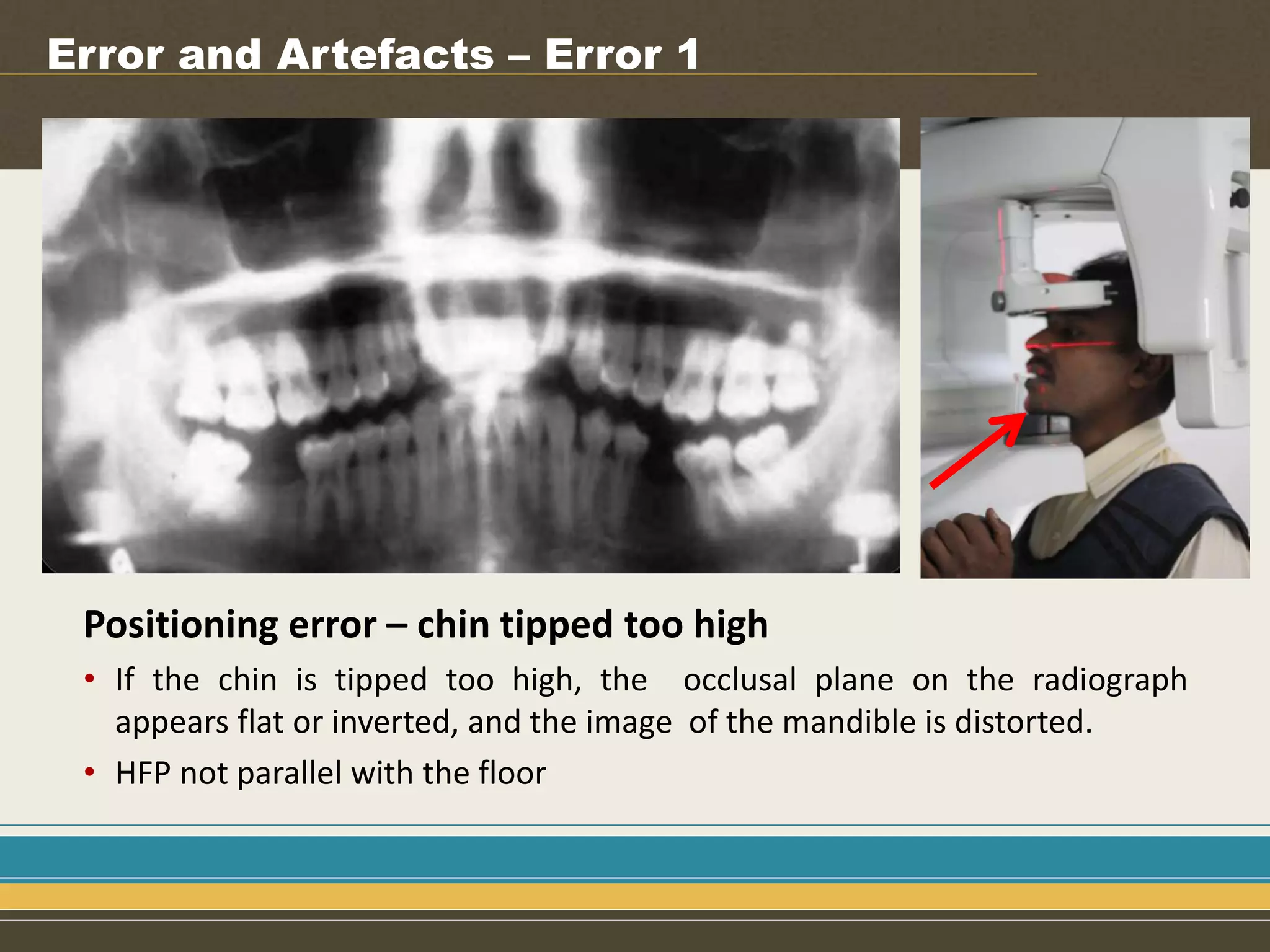 Opg and lateral cephalometric | PPT
