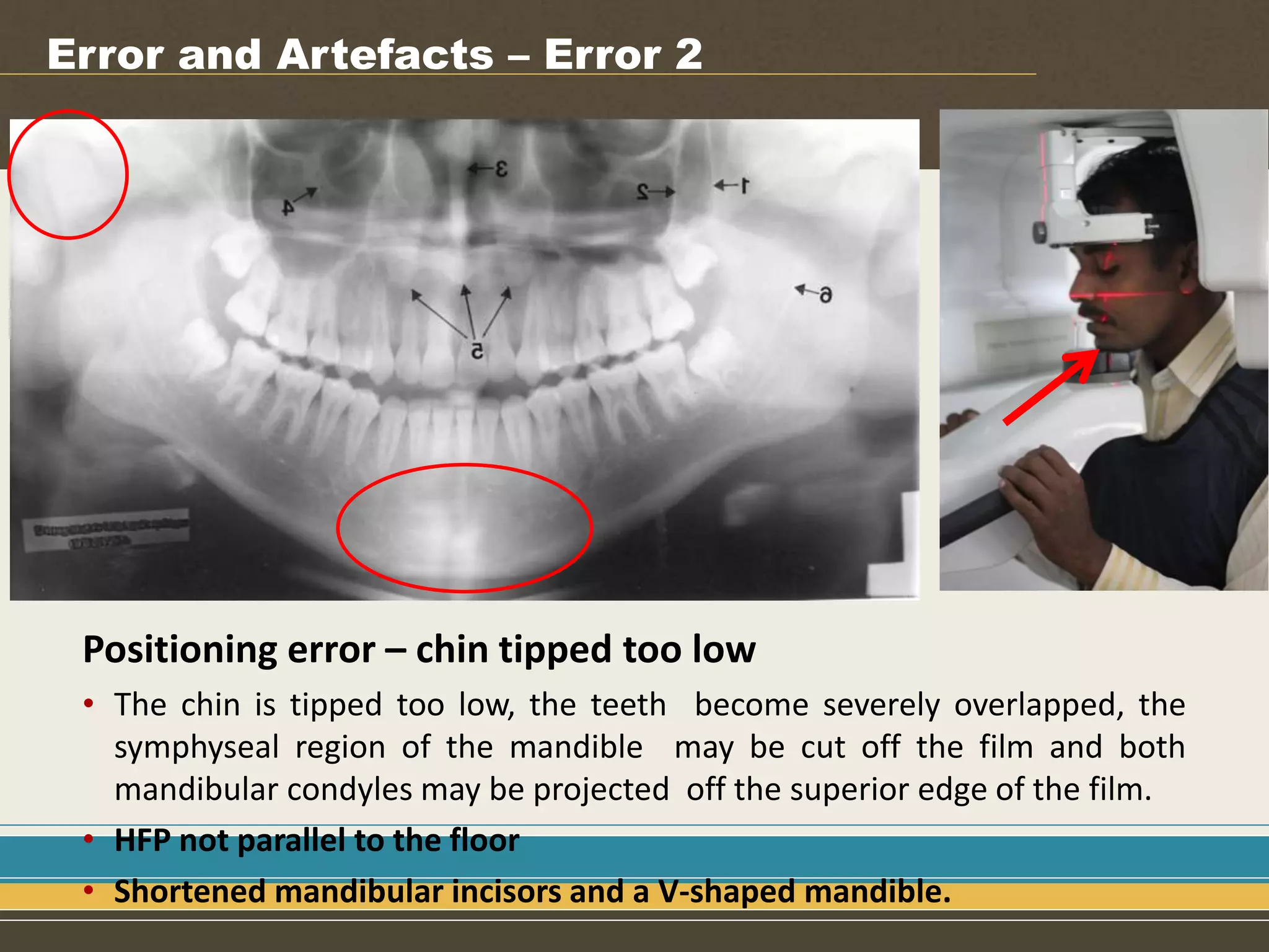 Opg and lateral cephalometric | PPT