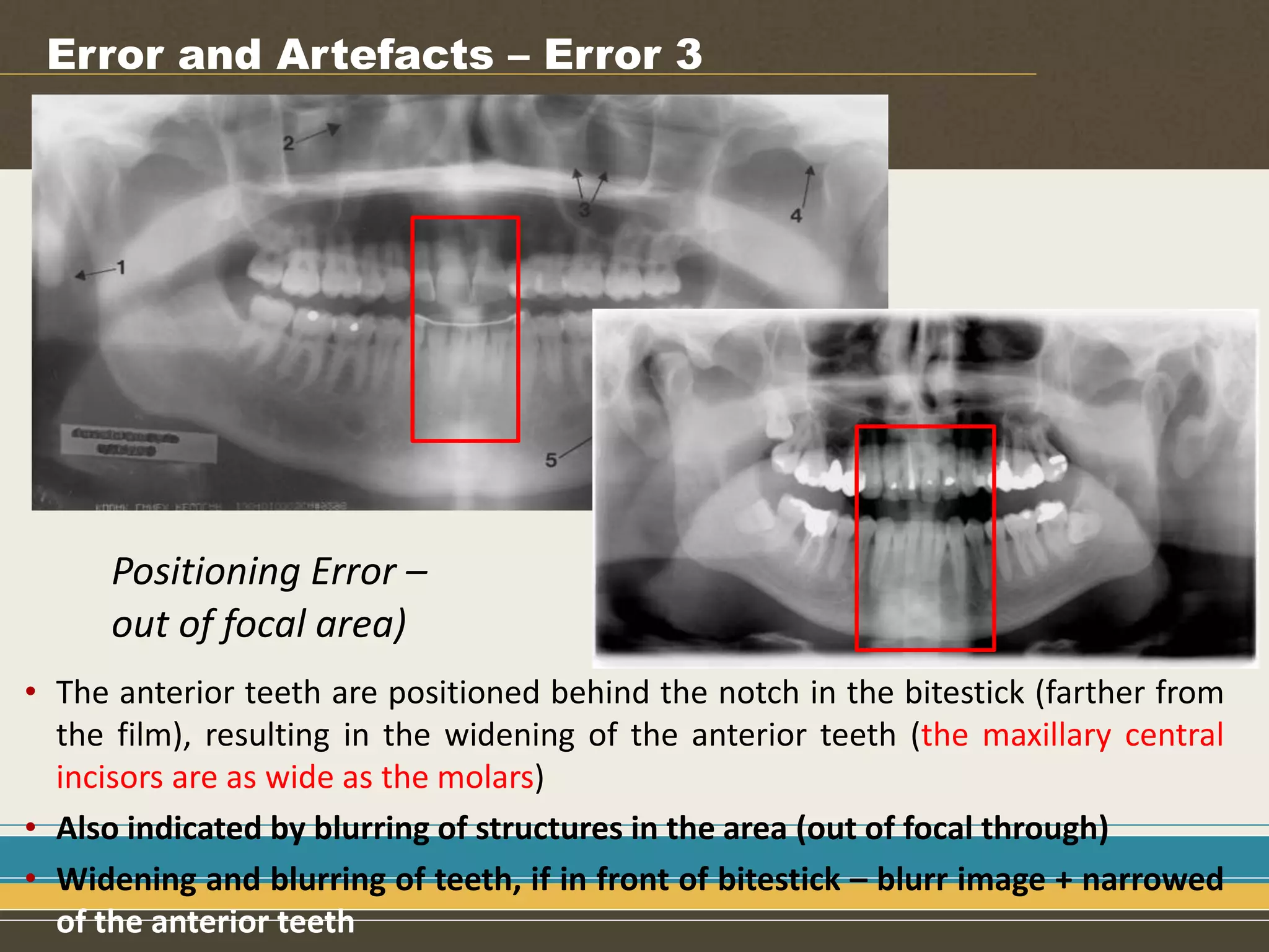 Opg and lateral cephalometric | PPT