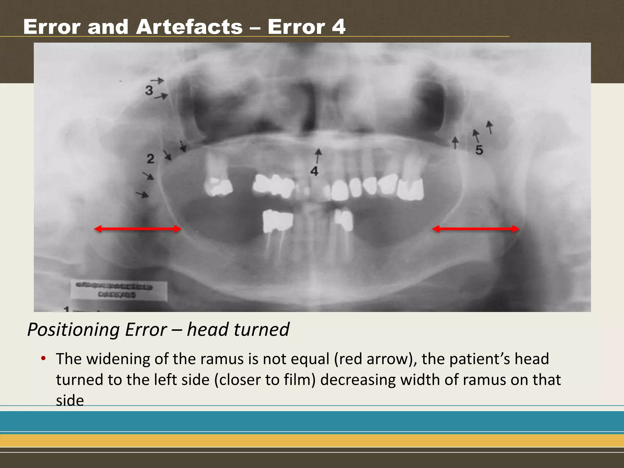 Opg and lateral cephalometric | PPT