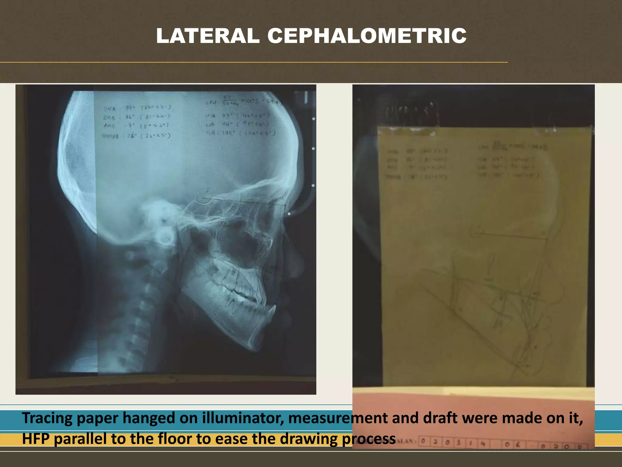 Opg and lateral cephalometric | PPT