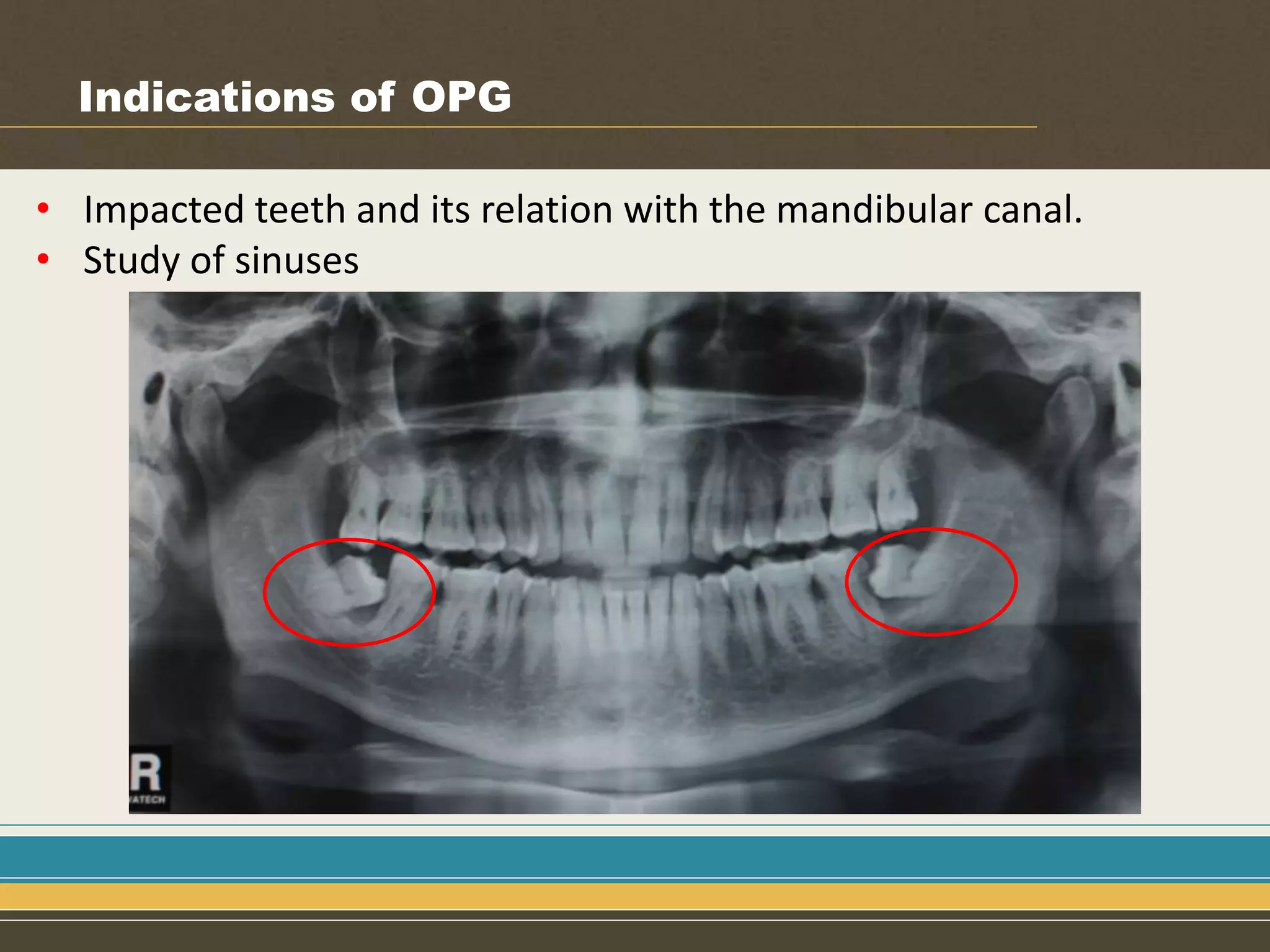 Opg and lateral cephalometric | PPT