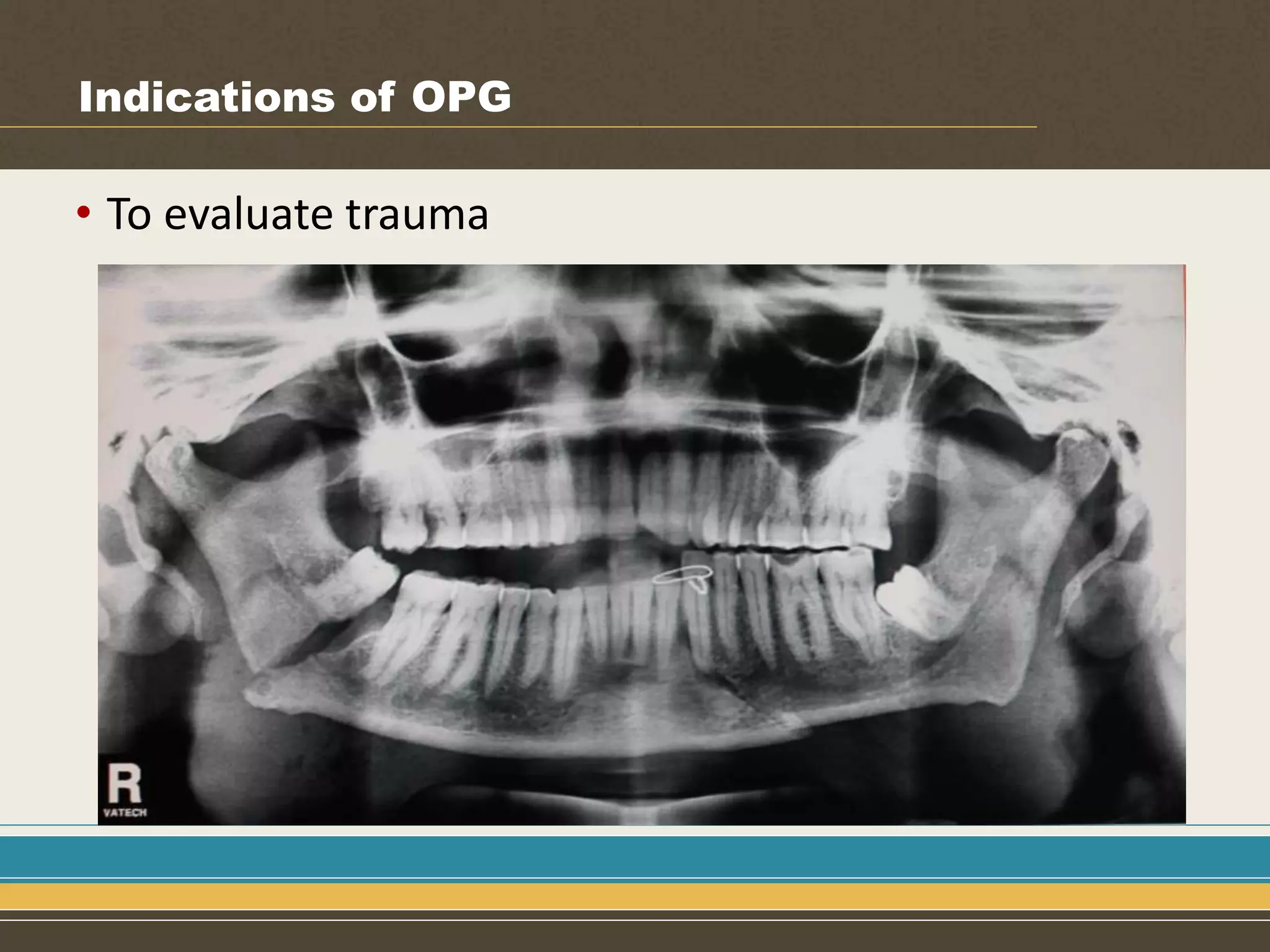 Opg and lateral cephalometric | PPT