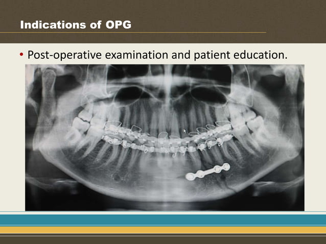 Opg and lateral cephalometric | PPT | Dental Health | Diseases and ...