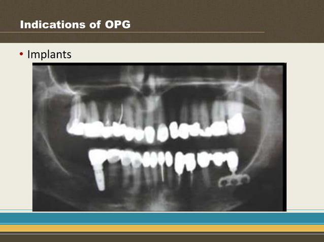 Opg and lateral cephalometric | PPT | Dental Health | Diseases and ...
