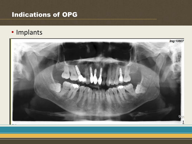 Opg and lateral cephalometric | PPT | Dental Health | Diseases and ...