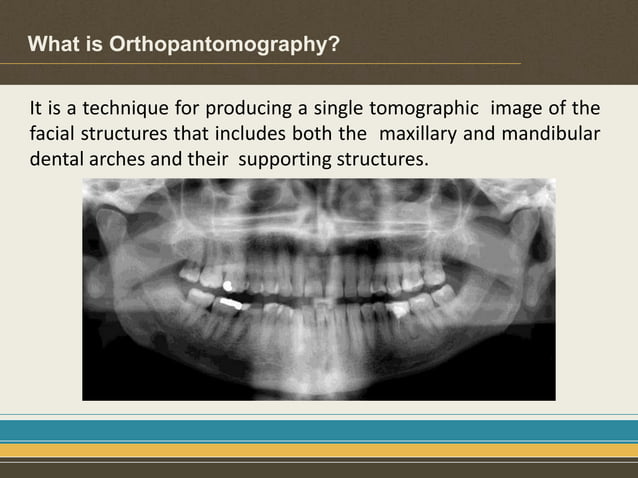 Opg and lateral cephalometric | PPT | Dental Health | Diseases and ...
