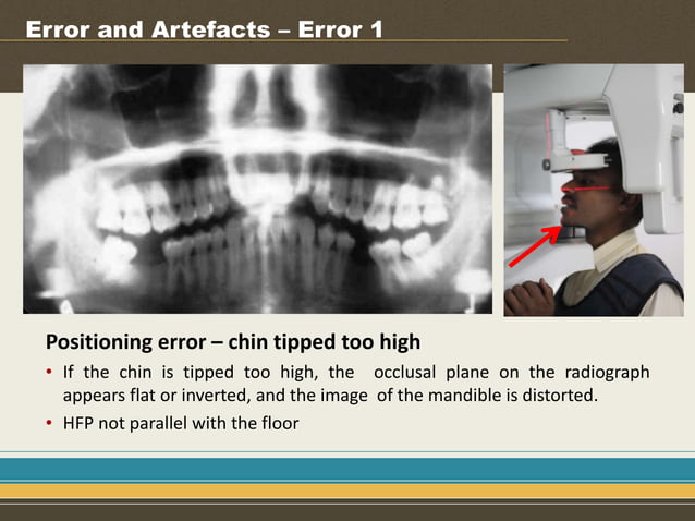 Opg and lateral cephalometric | PPT | Dental Health | Diseases and ...