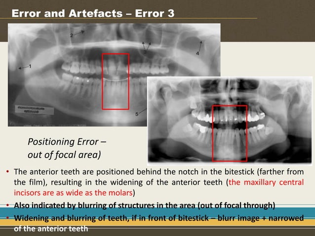 Opg and lateral cephalometric | PPT | Dental Health | Diseases and ...