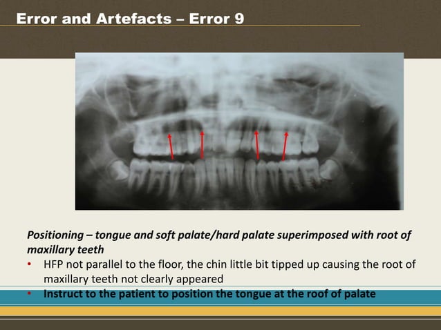 Opg and lateral cephalometric | PPT | Dental Health | Diseases and ...