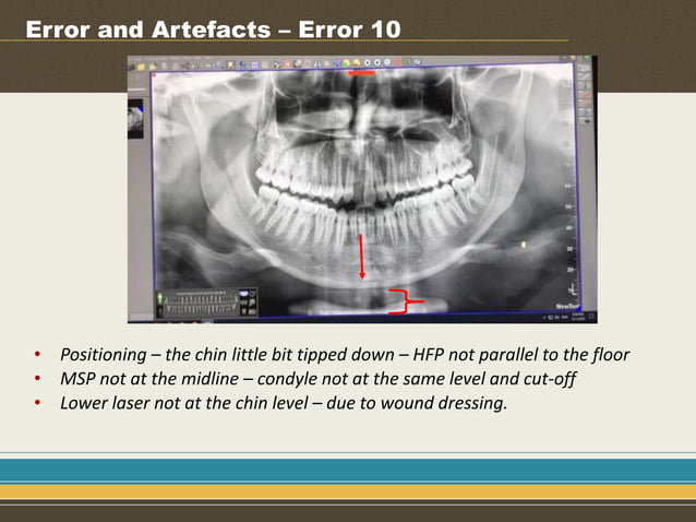 Opg and lateral cephalometric | PPT | Dental Health | Diseases and ...