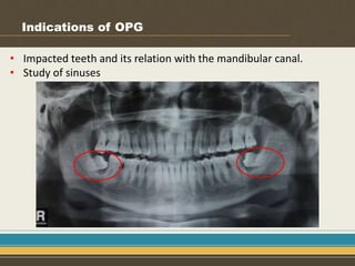 Opg and lateral cephalometric | PPT