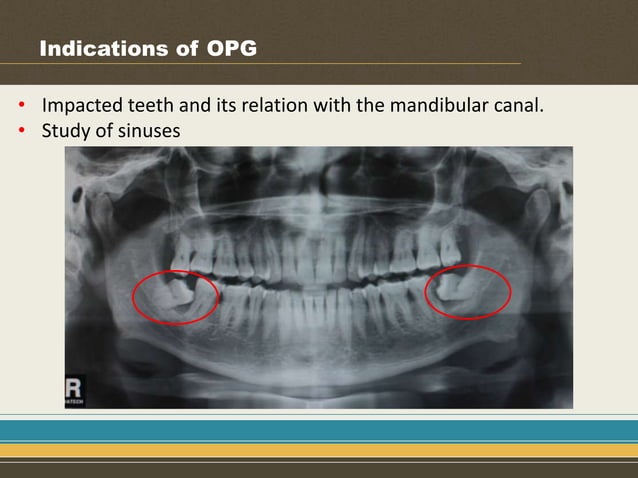 Opg and lateral cephalometric | PPT | Dental Health | Diseases and ...