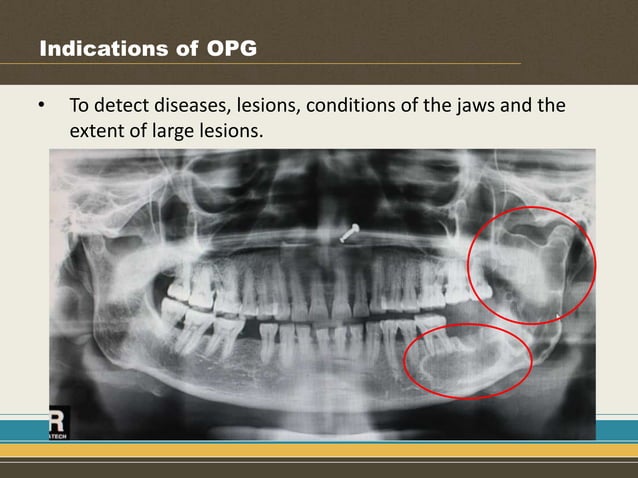 Opg and lateral cephalometric | PPT | Dental Health | Diseases and ...