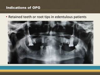 Opg and lateral cephalometric | PPT