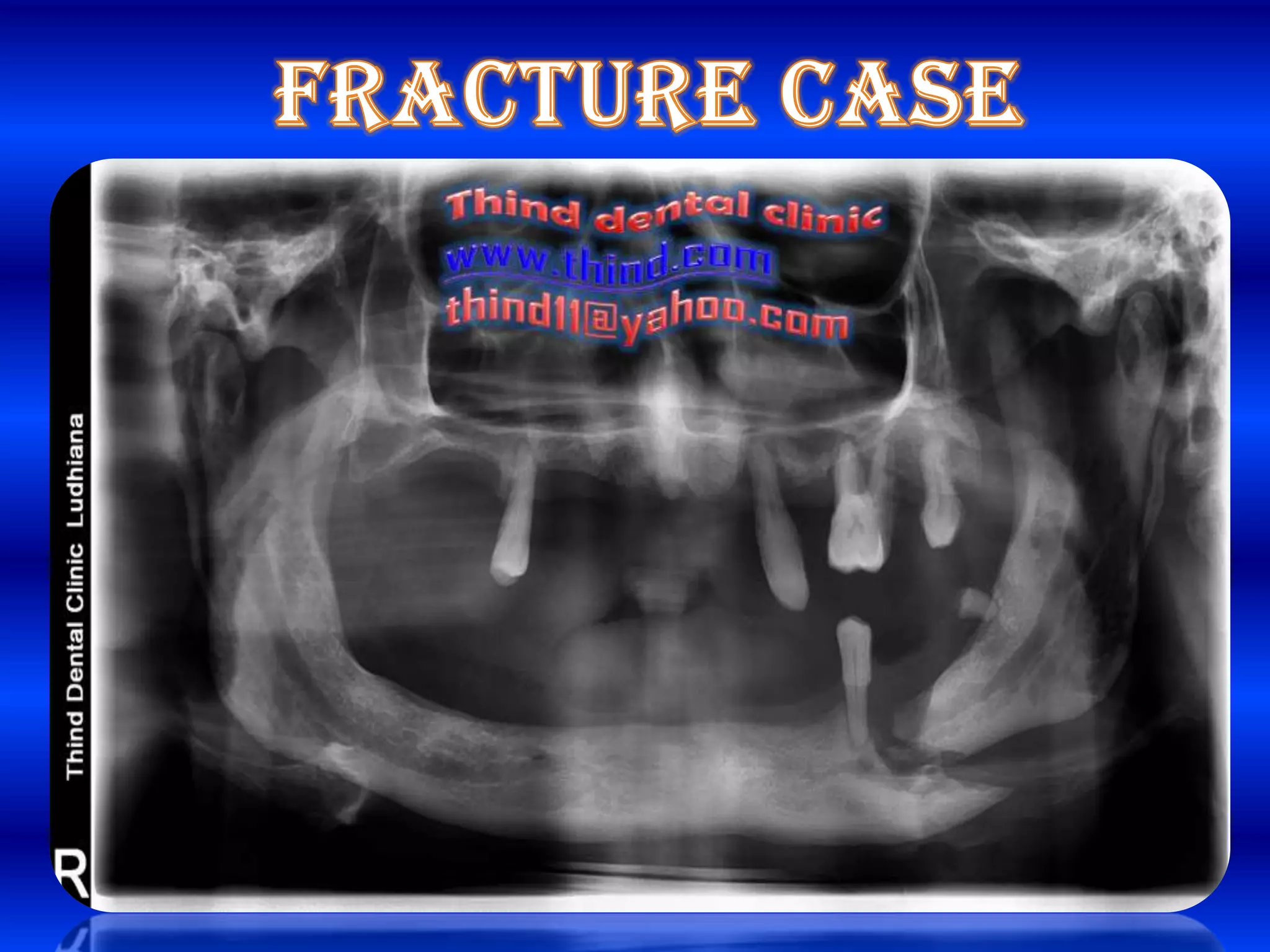 Opg cases ,Thind Dental clinic | PPTX