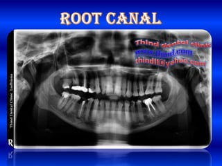 Opg cases ,Thind Dental clinic | PPTX