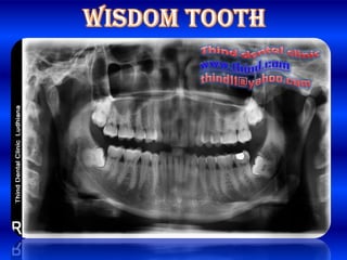 Opg cases ,Thind Dental clinic | PPTX