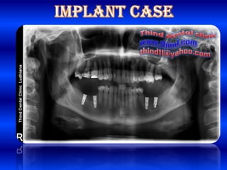 Opg cases ,Thind Dental clinic | PPTX
