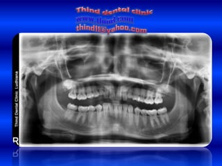Opg cases ,Thind Dental clinic | PPTX