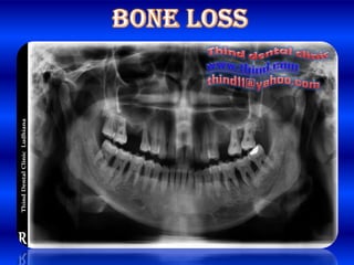 Opg cases ,Thind Dental clinic | PPTX