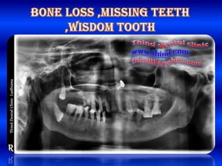 Opg cases ,Thind Dental clinic | PPTX