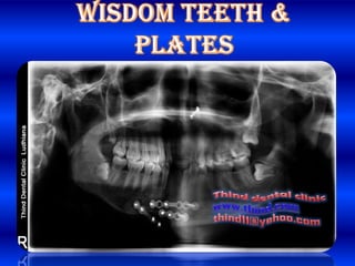 Opg cases ,Thind Dental clinic | PPTX